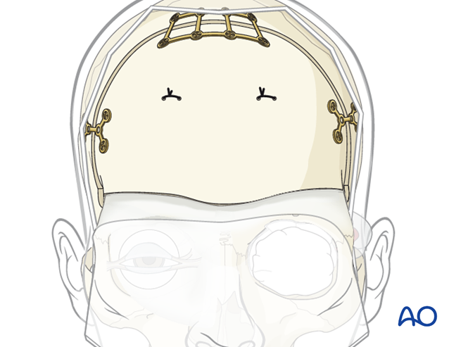 Pericranial and temporoparietal fascia flap for Anterior skull base ...