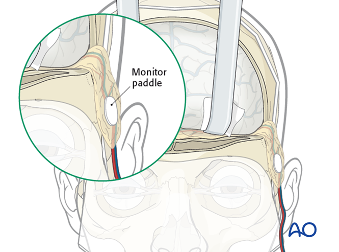 Radial forearm fasciocutaneous free flap for Anterior skull base ...