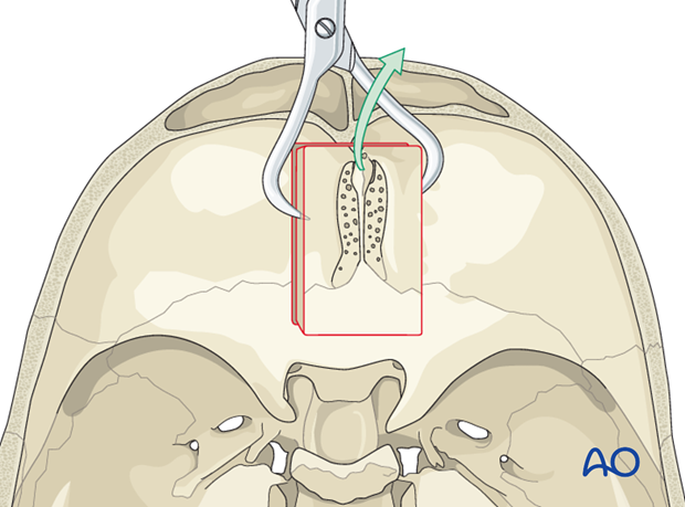 Pericranial flap for Anterior skull base without orbital involvement