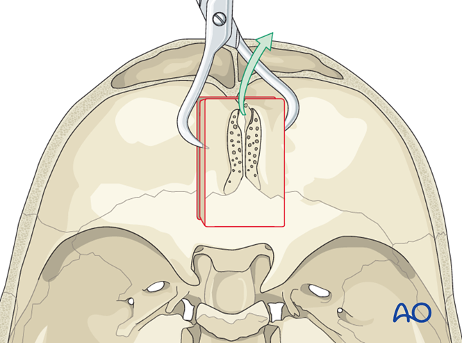 Pericranial flap for Anterior skull base without orbital involvement