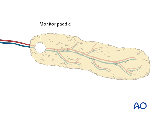 Radial forearm fasciocutaneous free flap for Anterior skull base ...