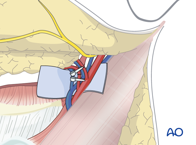 Plate and iliac crest internal oblique free flap for Symphysis, mucosa ...