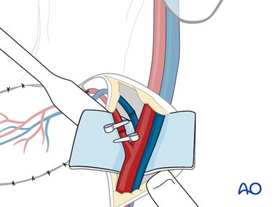 Plate and radial forearm fasciocutaneous free flap for Lateral mandible ...
