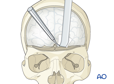Access osteotomy - Frontal craniotomy