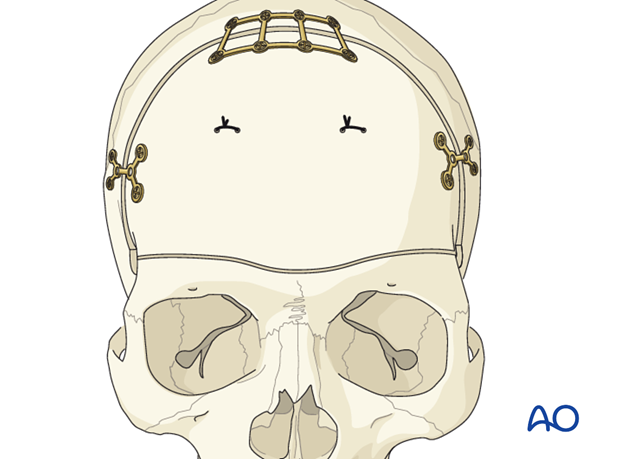 Access osteotomy - Frontal craniotomy