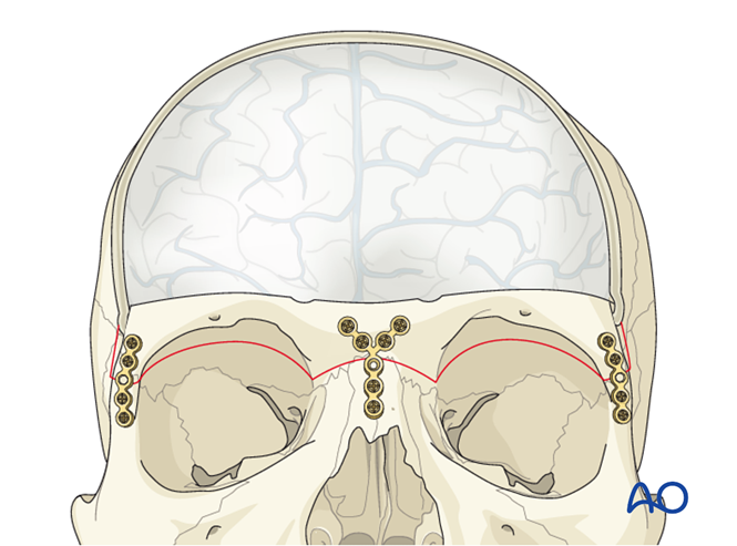 Access osteotomy - Extended frontal craniotomy