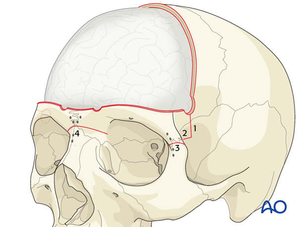 Access osteotomy - Extended frontal craniotomy