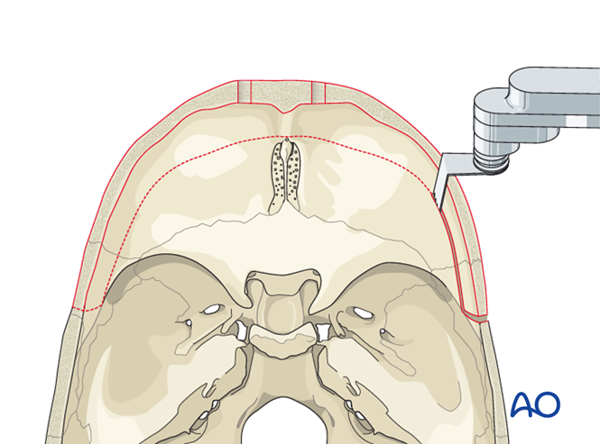 Access osteotomy - Extended frontal craniotomy