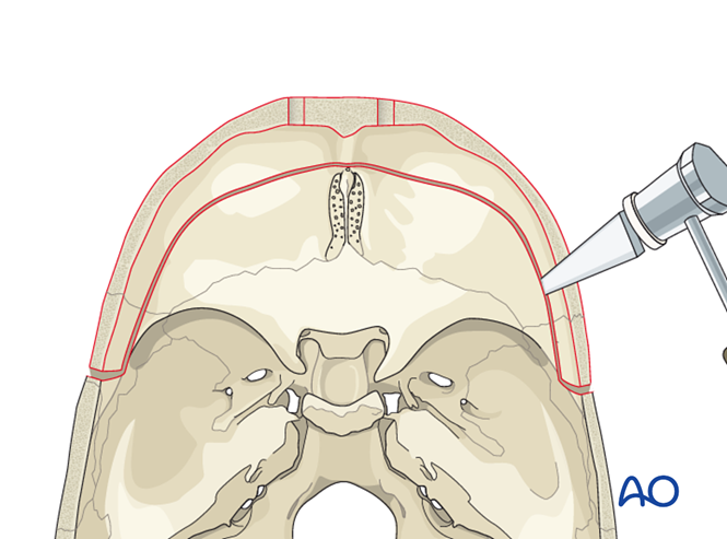 Access osteotomy - Extended frontal craniotomy