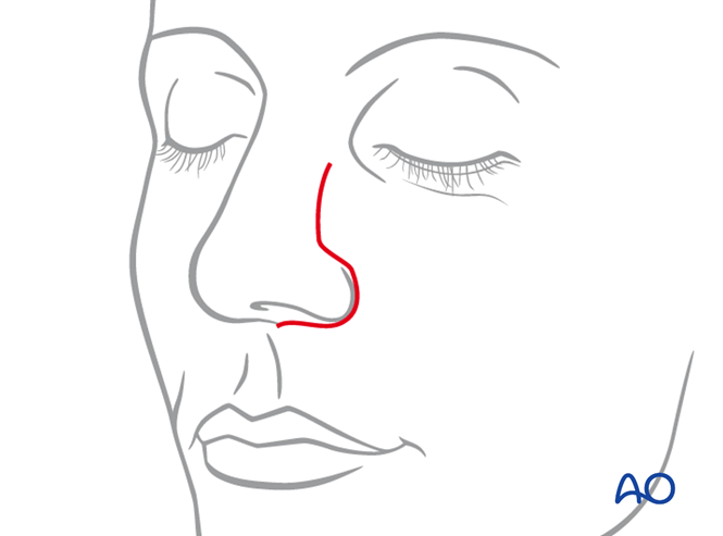Access osteotomy - Lateral Rhinotomy