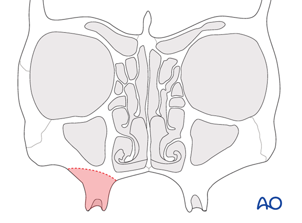 Introduction to and classification of midface resections