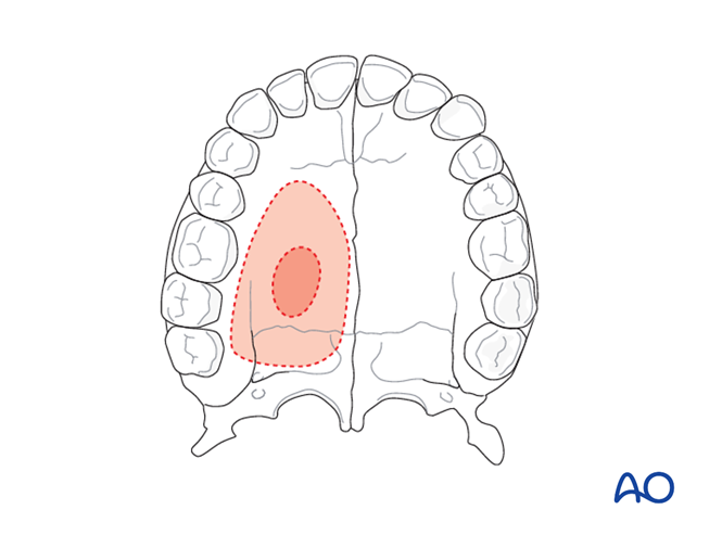 Introduction to and classification of midface resections