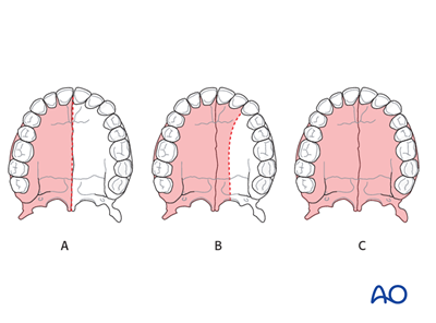 Introduction to and classification of midface resections