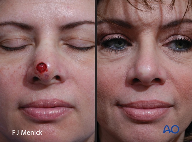 Full thickness skin graft for Small superficial defect