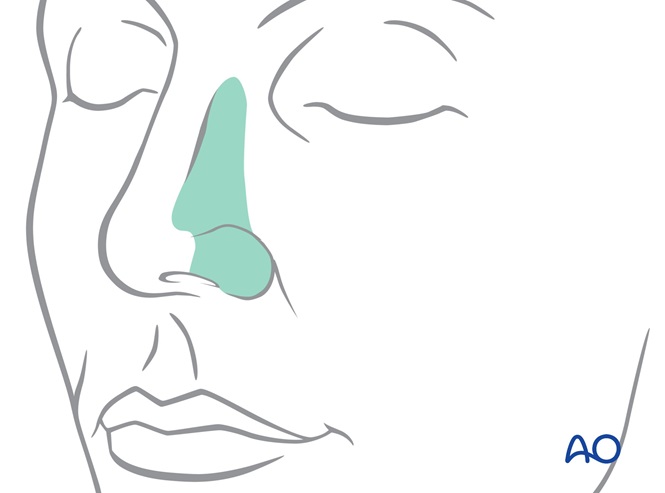One stage nasolabial flap for Small superficial defect