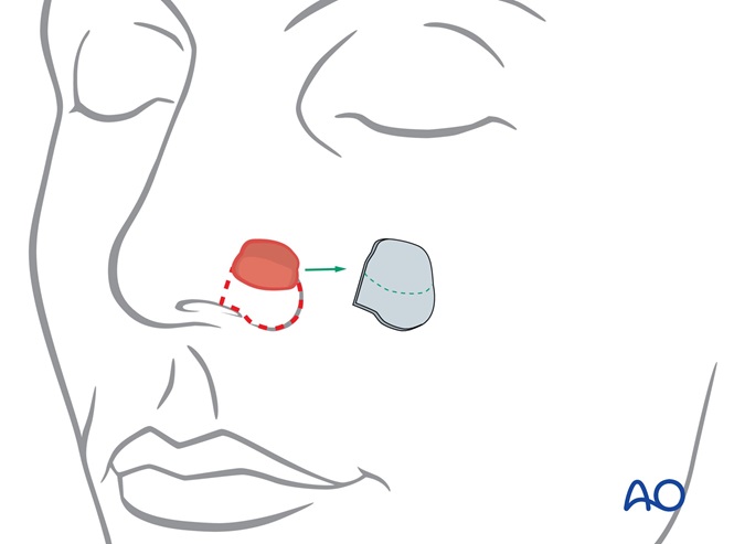 One stage nasolabial flap for Small superficial defect