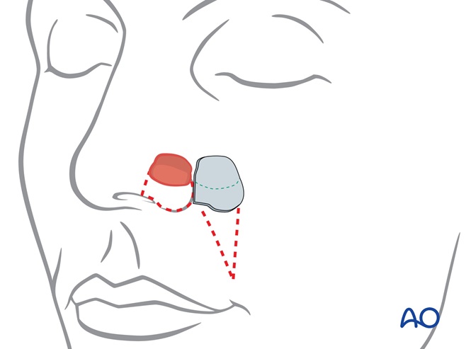 One stage nasolabial flap for Small superficial defect