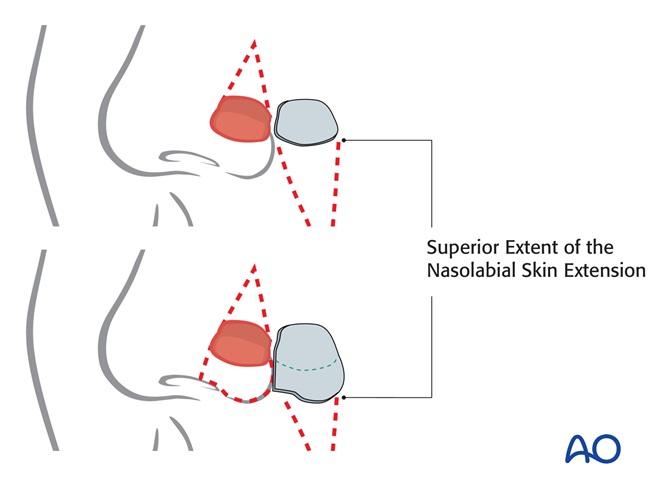 One stage nasolabial flap for Small superficial defect
