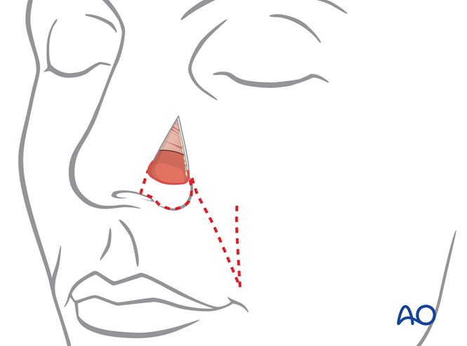 One stage nasolabial flap for Small superficial defect
