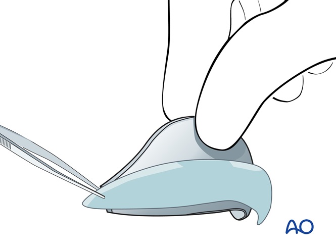One stage nasolabial flap for Small superficial defect