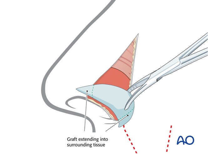 One stage nasolabial flap for Small superficial defect