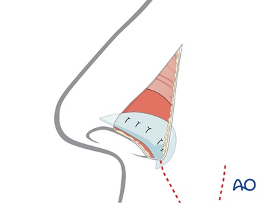 One stage nasolabial flap for Small superficial defect