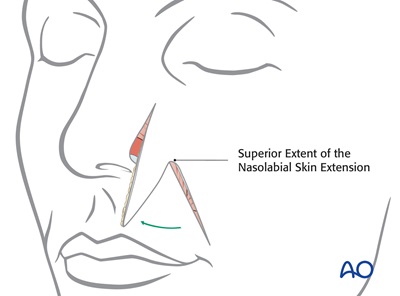 One stage nasolabial flap for Small superficial defect