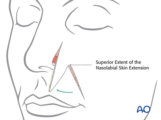 One stage nasolabial flap for Small superficial defect