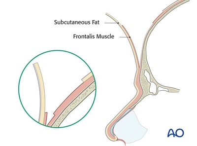 Two stage forehead flap - Ala reconstruction for Large partial ...