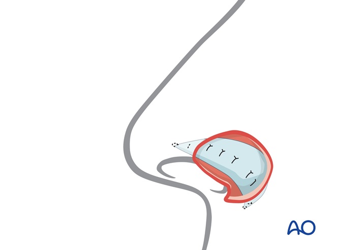 Two stage forehead flap - Ala reconstruction for Large partial ...