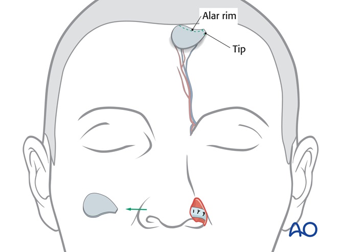 Two stage forehead flap - Ala reconstruction for Large partial ...
