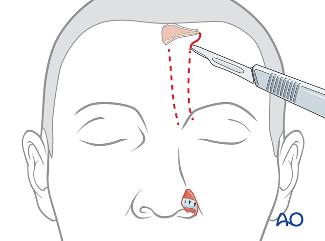 Two stage forehead flap - Ala reconstruction for Large partial ...