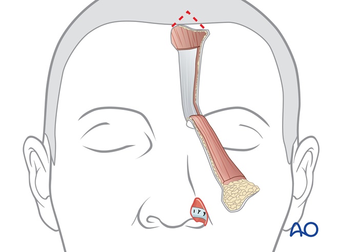 Two stage forehead flap - Ala reconstruction for Large partial ...