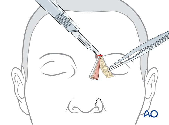 Two stage forehead flap - Ala reconstruction for Large partial ...