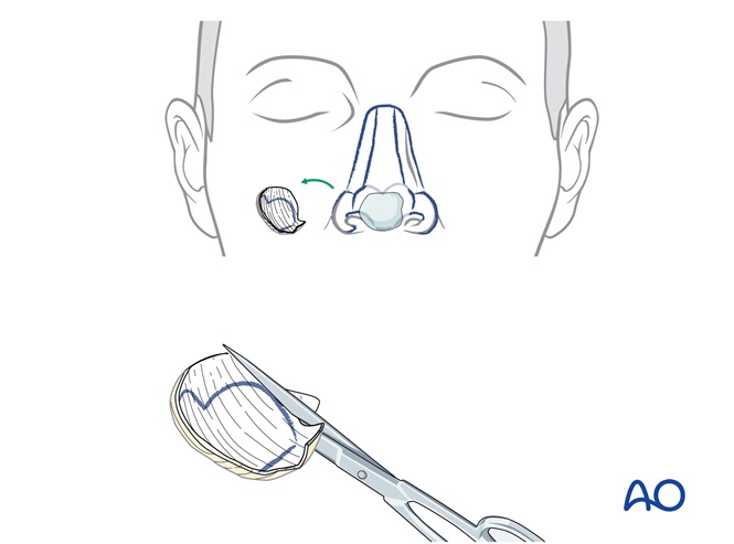 Two stage forehead flap - Tip reconstruction for Large partial ...