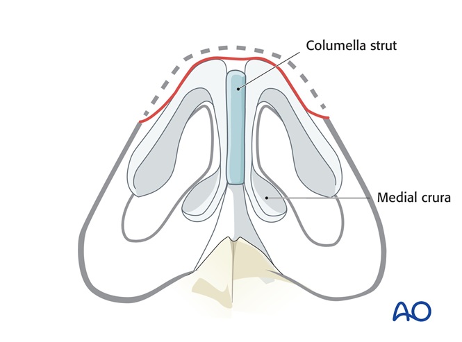 Two stage forehead flap - Tip reconstruction for Large partial ...