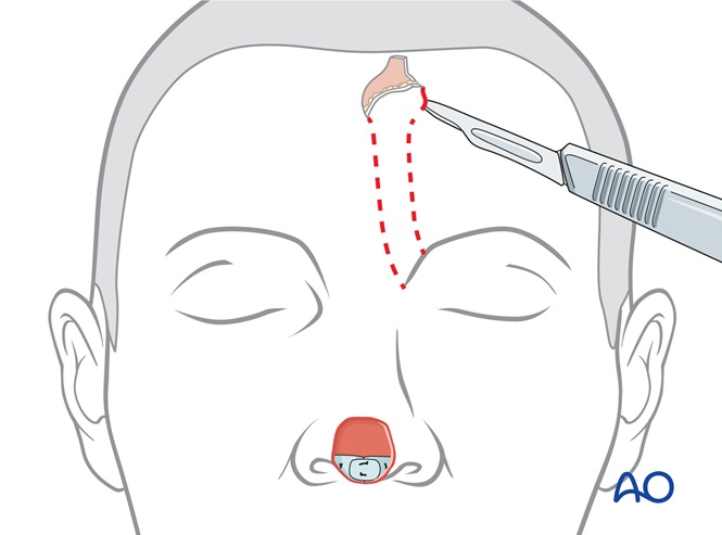 Two stage forehead flap - Tip reconstruction for Large partial ...