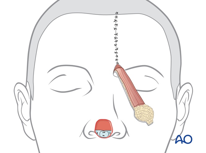Two stage forehead flap - Tip reconstruction for Large partial ...
