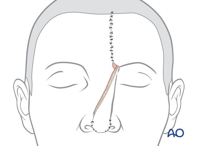 Two stage forehead flap - Tip reconstruction for Large partial ...
