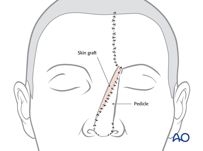 Two stage forehead flap - Tip reconstruction for Large partial ...