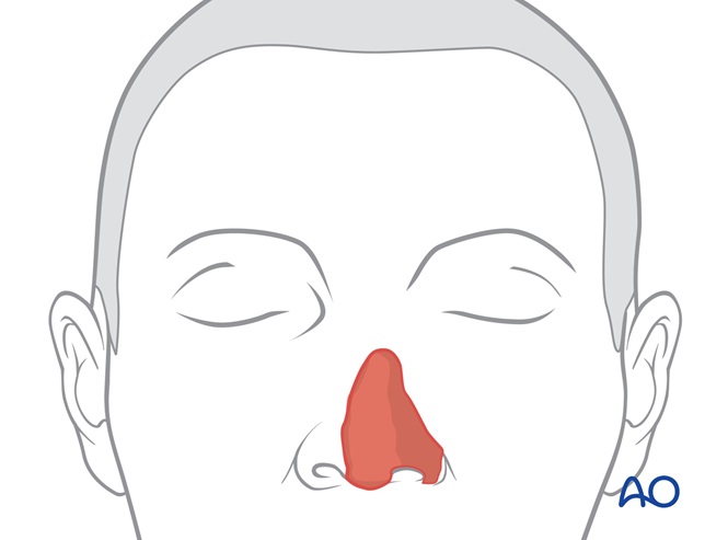 Three stage forehead flap for Large partial thickness defect