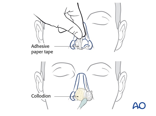 Three stage forehead flap for Large partial thickness defect
