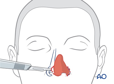 Three stage forehead flap for Large partial thickness defect