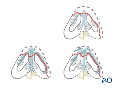 Three stage forehead flap for Large partial thickness defect