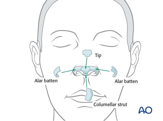 Three stage forehead flap for Large partial thickness defect