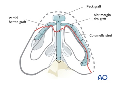 Three stage forehead flap for Large partial thickness defect