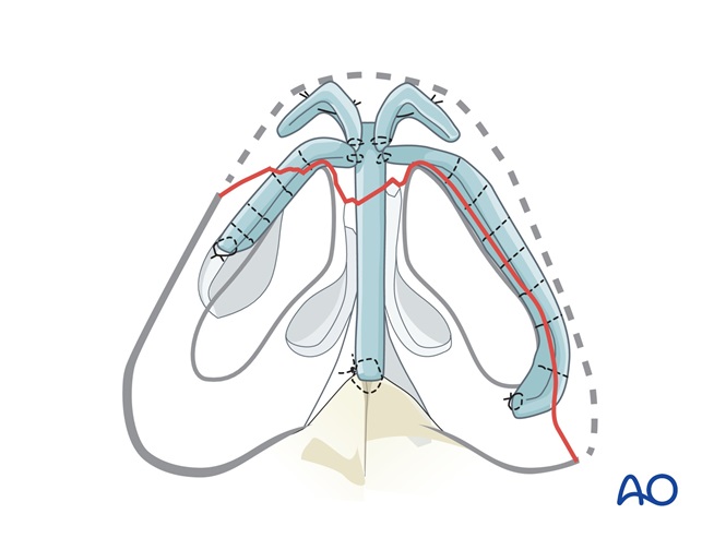 Three stage forehead flap for Large partial thickness defect