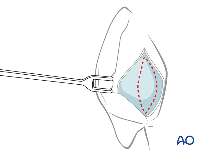 Three stage forehead flap for Large partial thickness defect
