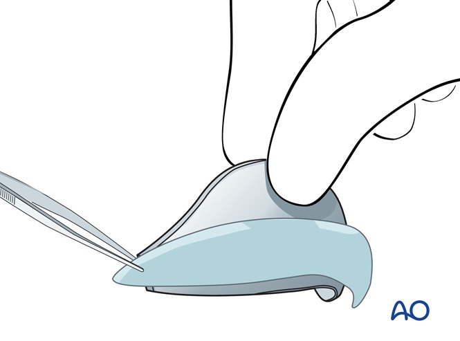 Three stage forehead flap for Large partial thickness defect
