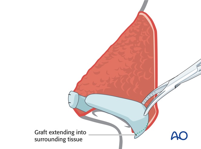 Three stage forehead flap for Large partial thickness defect